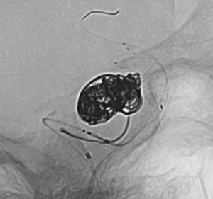 ACCERO® Stent - Acandis
