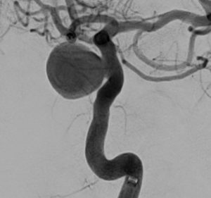 DERIVO® 2heal® Embolisation Device - acandis