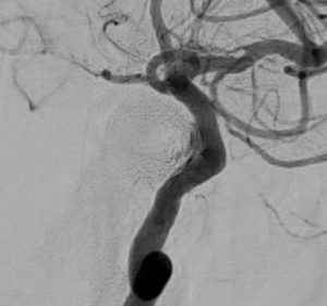 DERIVO® 2heal® Embolisation Device - acandis