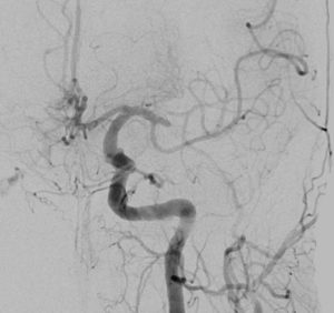APERIO® Hybrid17|21 Thrombectomy Device - Acandis