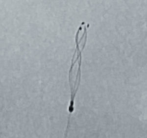 APERIO® Hybrid17|21 Thrombectomy Device - Acandis