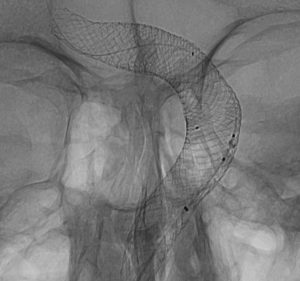 ACCERO® Rex Stent - Acandis